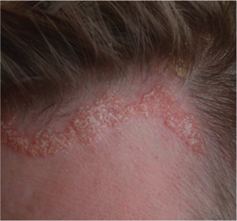 Scalp Psoriasis Adalah Seborrhoeic Dermatitis - Johnny Depp Case